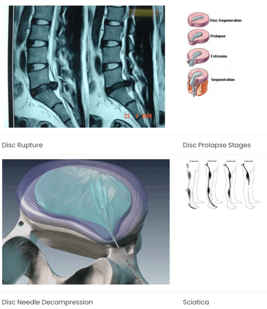 Slip Disc & Sciatica - Spine Disc & Pain Specialist - Dr. Neeraj Jain ...